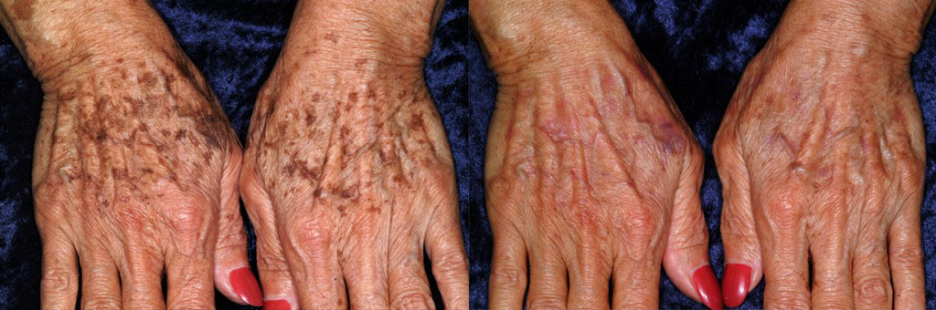 IPL Before and After Photos (Intense Pulse Light) by Mayoral Derm