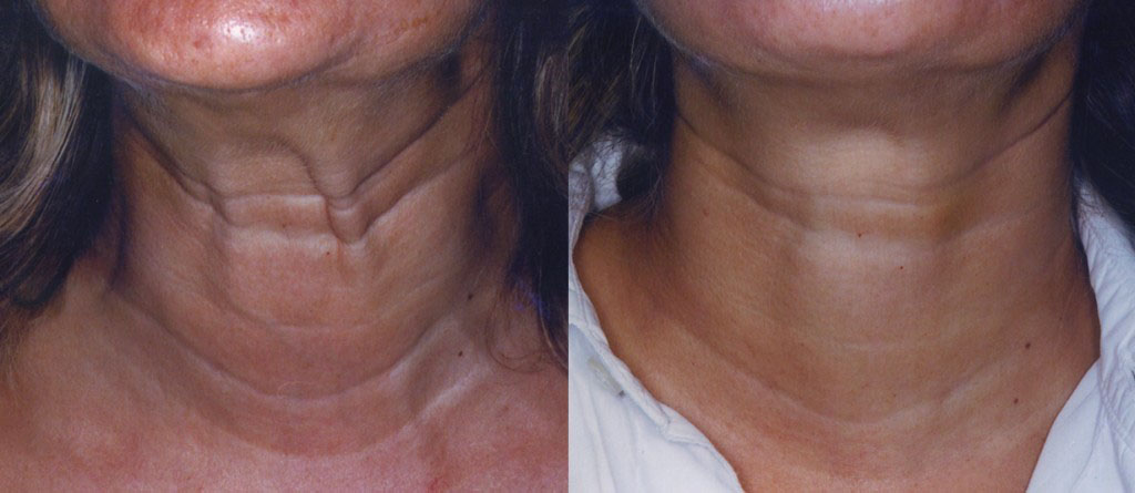 Botox® Cosmetic Before and After Photos by Dr. Flor A. Mayoral, MD