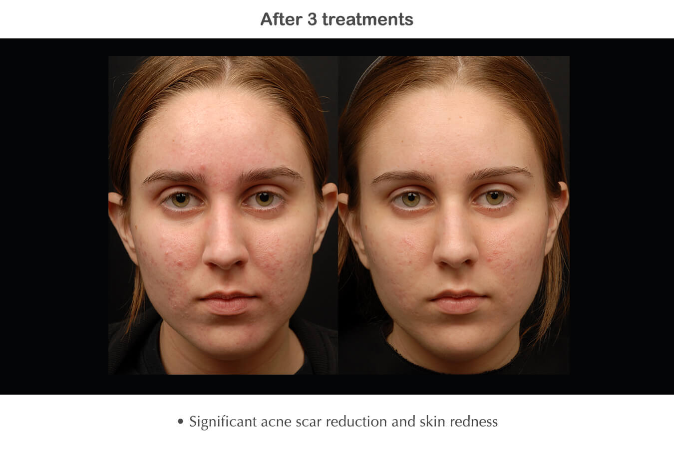 Fractional RF for Acne - Mayoral Dermatology