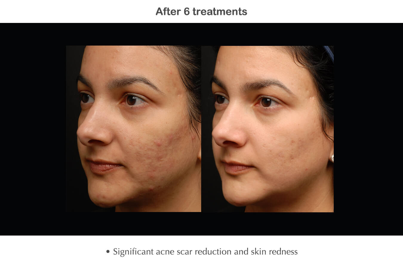 Fractional RF for Acne - Mayoral Dermatology