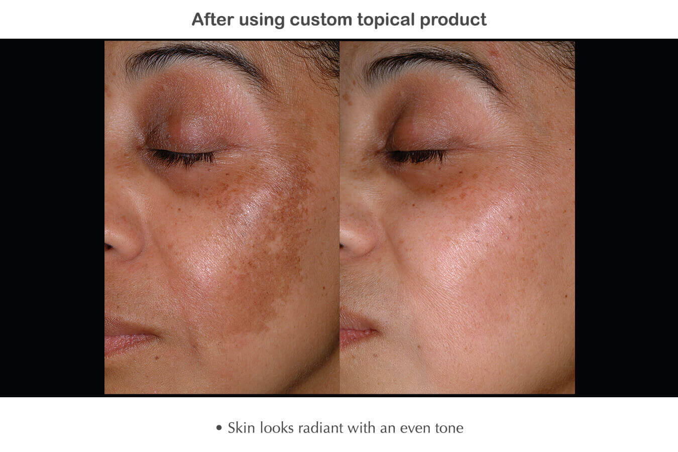 Melasma & Brown Spots - Mayoral Dermatology