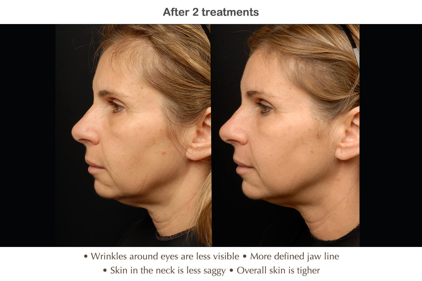 Fractional RF for Rejuvenation - Mayoral Dermatology